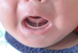 Frenotomía. Diagnóstico y tratamiento fisioterapia – Fisioterapia Vicetto